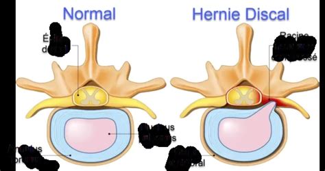 Cervical Disc Herniation Osteomag