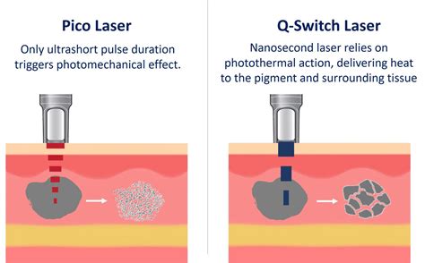 A Complete Guide To Pico Laser Treatment Dream Plastic Surgery