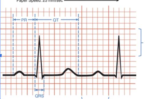 ECG Graphs Flashcards Quizlet