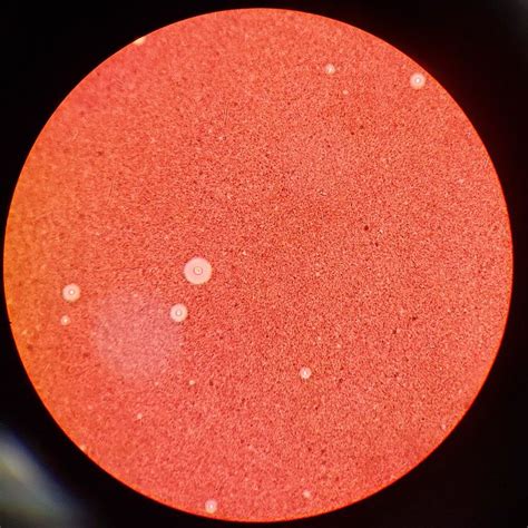 Cryptococcus Spp In Cerebrospinal Fluid Sample