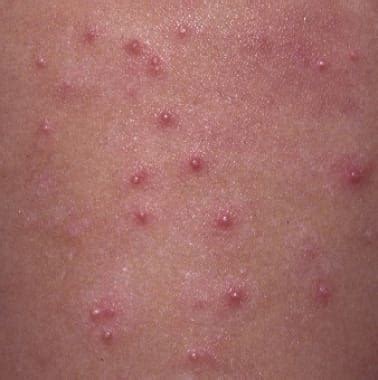 Molluscum Contagiosum Background Pathophysiology Etiology