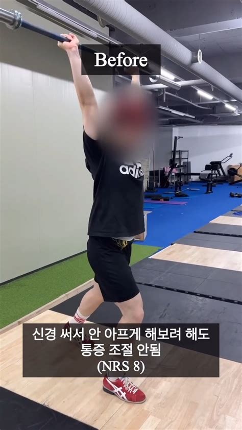 이재준 연구소장 나이가 있으신 분들은 허리통증과 다리가 저린 증상이 있으면 요추관협착증 진단을 받기 쉽습니다 그런데 60세
