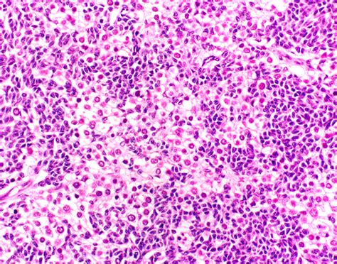 Pathology Outlines Adult Granulosa Cell Tumor