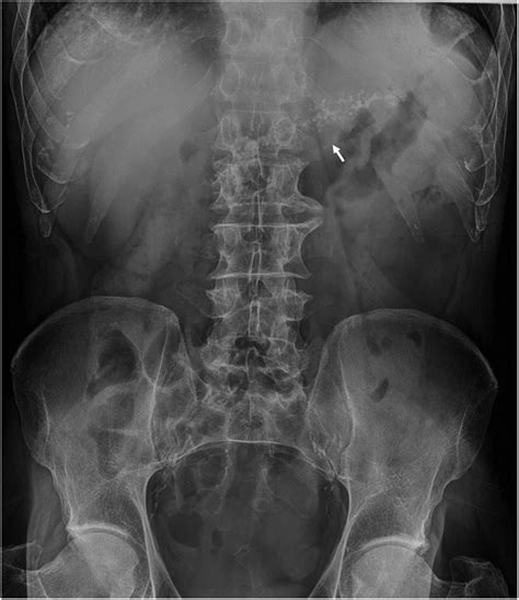 Pancreatitis crónica: diagnóstico por imagen | Medicina de Familia. SEMERGEN