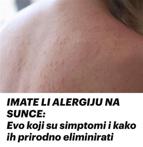 IMATE LI ALERGIJU NA SUNCE? Evo koji su simptomi i kako ih prirodno eliminirati | Mega Vijesti