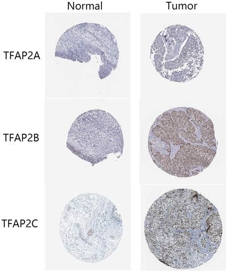 Comprehensive Analysis Of Prognostic Value And Immune Infiltration Of