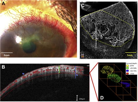 Novel Parameters To Assess The Severity Of Corneal Neovascularization Using Anterior Segment