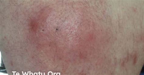 Panniculitis Image