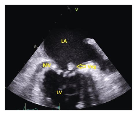 Transesophageal Echocardiogram Tee Showing A 063 Cm × 054 Cm