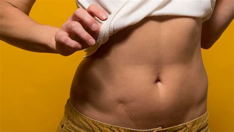 Apendicectomia Dr Mario Enrique Galindo Domínguez