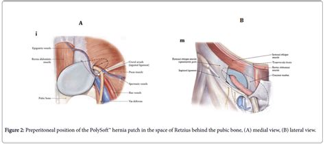 Long Term Follow Up Of A Large Series Of Patients Following Onste