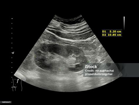 신장 결석 질환 또는 요로 결석 스크리닝을 위한 신장 또는 Kub의 초음파 0명에 대한 스톡 사진 및 기타 이미지 0명