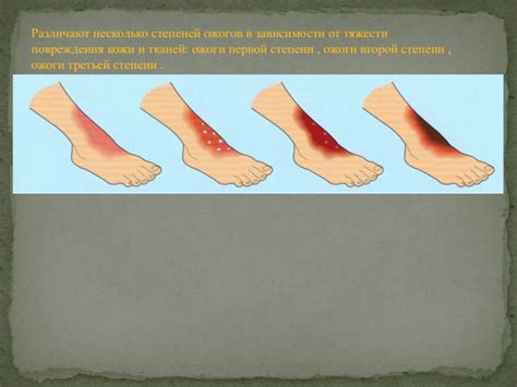 Ожоги презентация, доклад