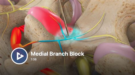 Services Medial Branch Blocks — Associated Surgical Center Of Dearborn