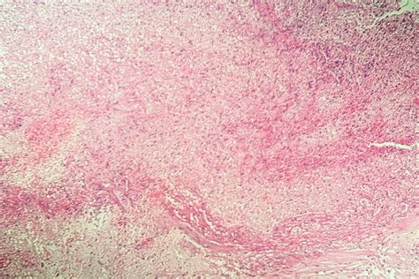 Gallbladder Necrosis Tissue Under The Microscope 100x Tissue Macro