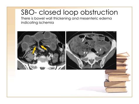 Ppt Bowel Obstruction Powerpoint Presentation Free Download Id 3378275