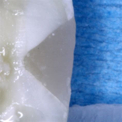 A Photograph Of V Shaped Class V Cavity B Photograph Of Cross Download Scientific Diagram