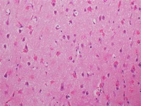 Hyaline Refractile Astrocytic Inclusions Mostly In Astrocytes Close To