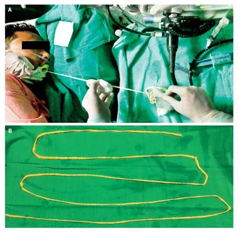 Mammoth 6ft Live Tapeworm Removed From Mans Gut Through His Mouth It