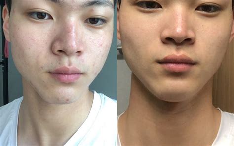 청소년 좁쌀 여드름 화장품 관리후기 방법 공유합니다
