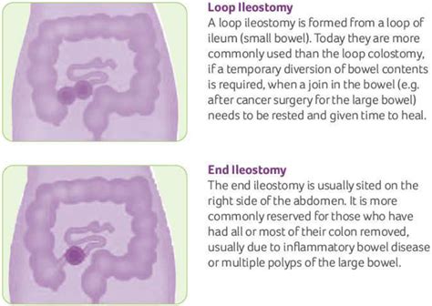 Ileostomy Vs Colostomy Colostomy Ileostomy Ostomy