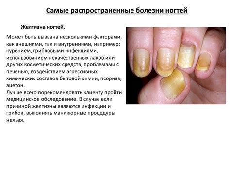 Наращивание ногтей на верхние формы - презентация онлайн