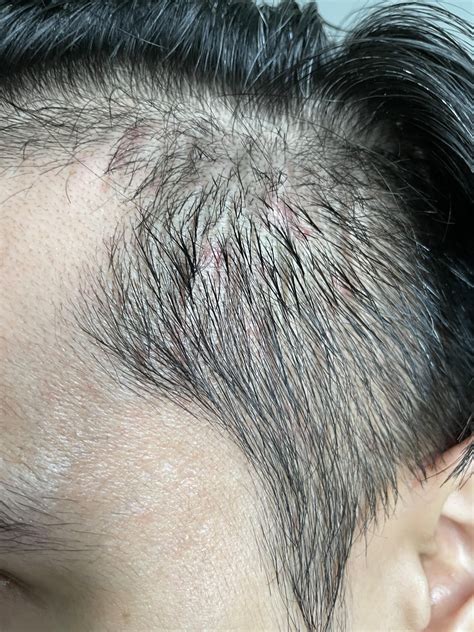 Unfortunately Im Back R Folliculitis