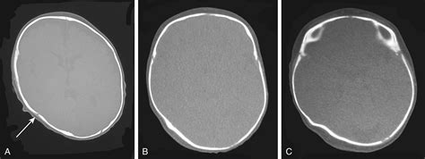 Lambdoid Craniosynostosis Clinical Tree