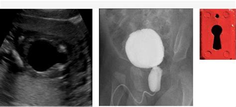 Micturating Cystourethrography Genitourinary Radiology