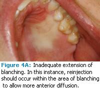 Effective Use Of The Amsa Nerve Block Dimensions Of Dental Hygiene