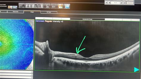 What Is This Oct Finding Roptometry