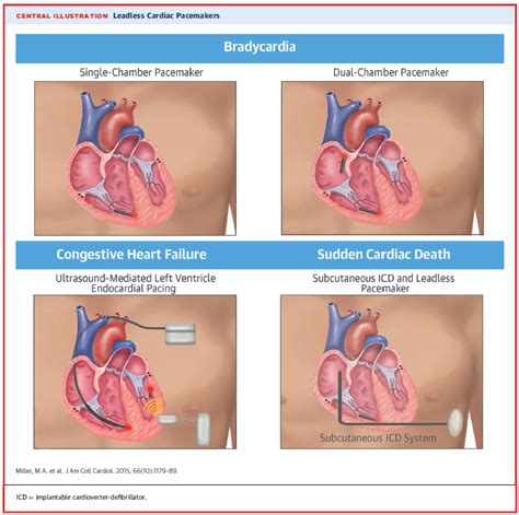 Permanent Leadless Cardiac Pacing American College Of Cardiology