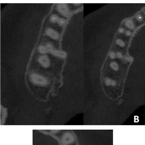 Cases Of Maxillary Permanent Molars With Root And Root Canal Variations Download Scientific