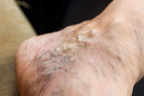 Superficial Thrombophlebitis Foot