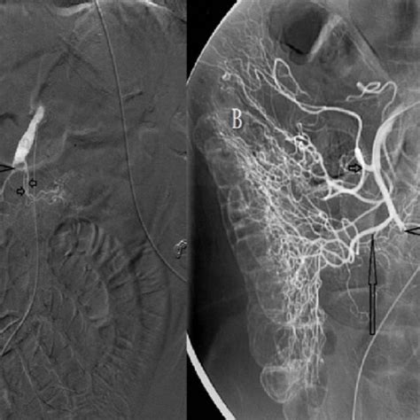 A Angiography Of An 83 Year Old Woman Showing Complete Occlusion Download Scientific Diagram