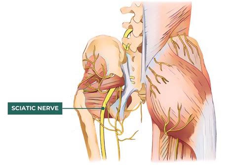 Whats The Difference Between A Pinched Nerve And Sciatica