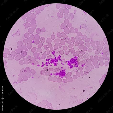 Blood Smear Show Anisocytosis And Target Cells Macrocytic Anemia With