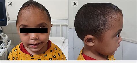 Clinical Image Showing Abnormal Skull Shape With Steeply Rising Download Scientific Diagram