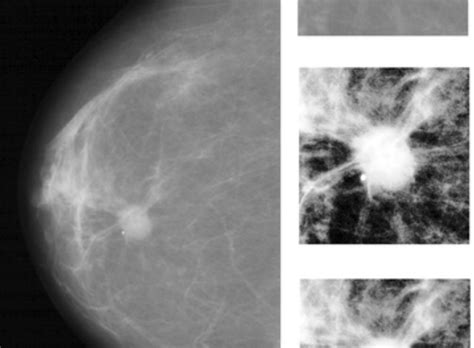 Automatic Characterization Of Breast Masses Using Nsga Ii Based Feature