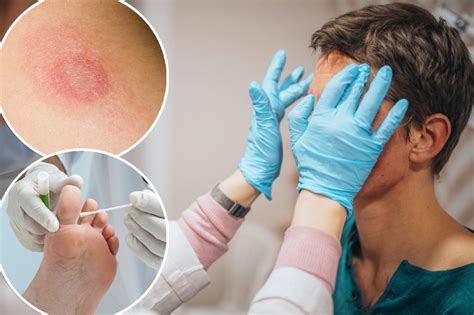 New Sexually Transmitted Fungal Infection Detected In Nyc — First Us Case Seemayo