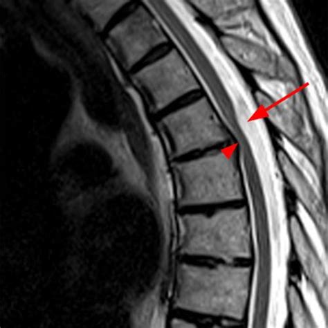 Arachnoid Web Spinal Dorsal Thoracic Arachnoid Web Nfhqwp