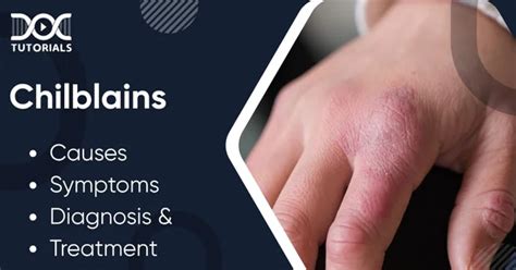 Chilblains Causes Symptoms Diagnosis And Treatment