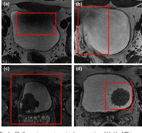 Figure 1 From Multiregion Segmentation Of Bladder Cancer Structures In Mri With Progressive