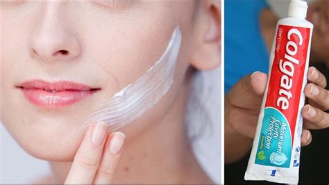 Does Toothpaste Lighten Acne Scars At Isabel Spiegel Blog