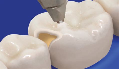 Bioclear Blaster Kit Clinical Research Dental