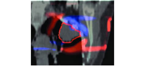B Dose Difference Map Between The Cumulative Dose And The Dose Download Scientific Diagram
