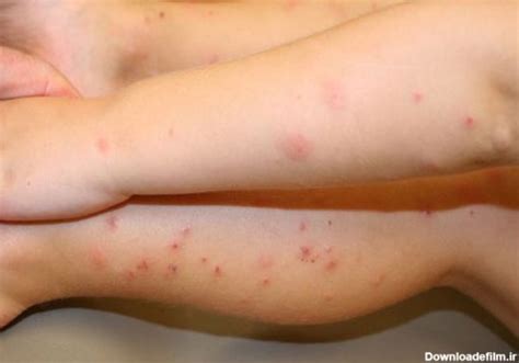 عکس جای نیش حشرات مختلف