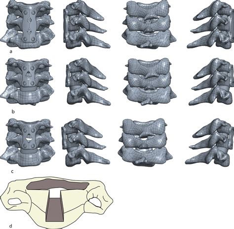 Finite Element Model Of The Cervical Spine Under Three Types Of