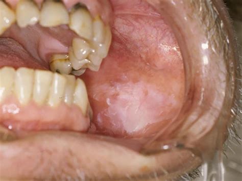 Leukoplakia Tonsil