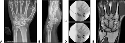 Front To Back Arthroscopic Repair Of Complete Lunotriquetral Ligament